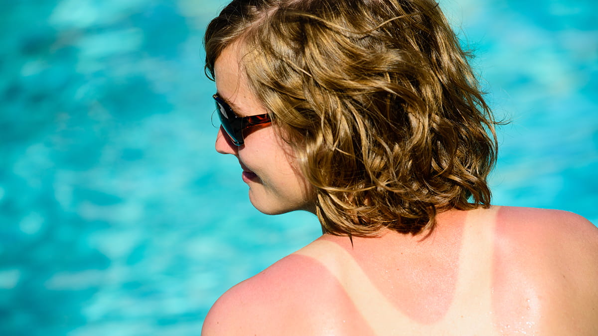 Put out the fire: Tips for treating sunburn | Ohio State Wexner Medical ...