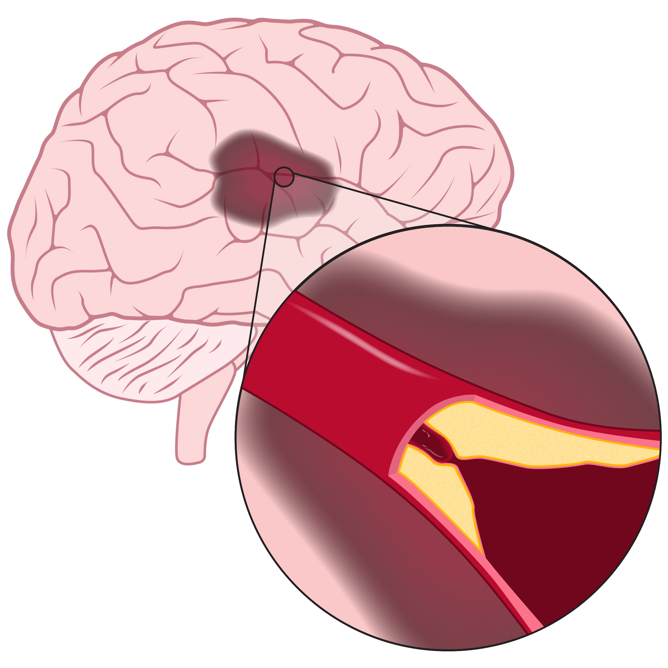 Types of Stroke | Ohio State Medical Center